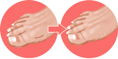 What is Minimally Invasive Foot Surgery - Bergman Foot Center